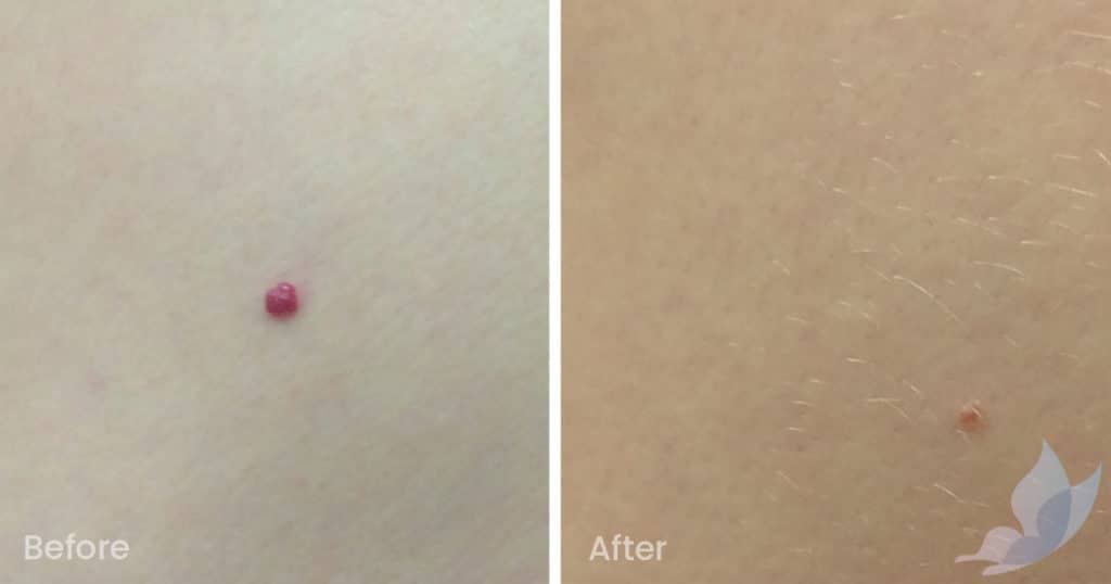 Birthmarks and Capillaries - Back - Austin Clinic