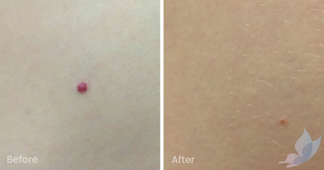 Birthmarks and Capillaries - Back - Austin Clinic