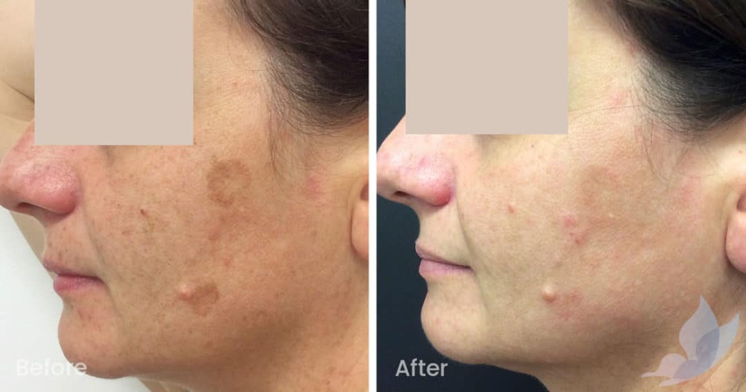 Sun damage - Left Cheek - Austin Clinic