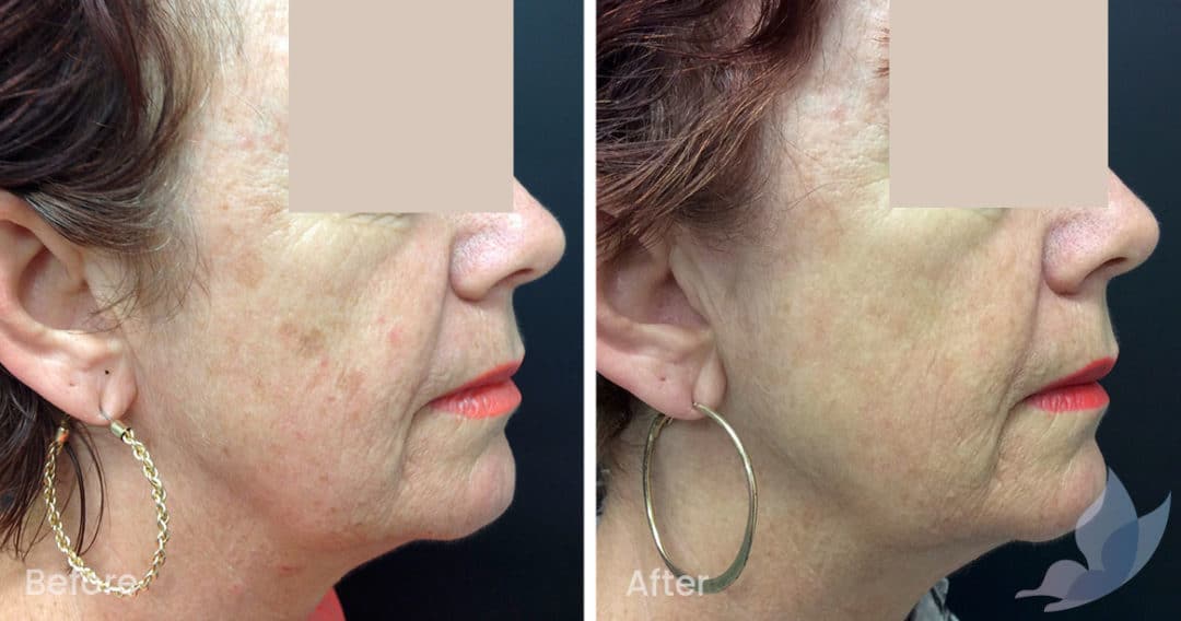 Sun damage - Right Cheek - Austin Clinic