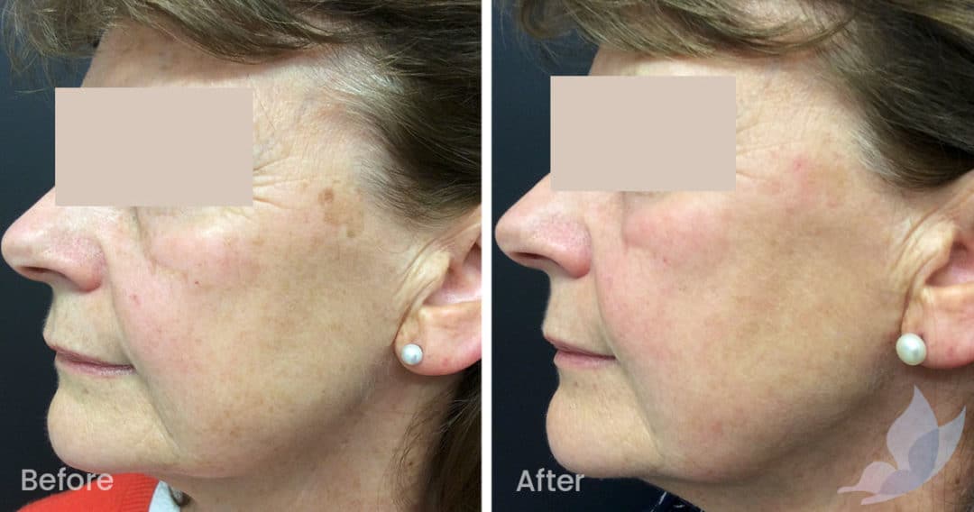 Sun damage - Left Cheek - Austin Clinic
