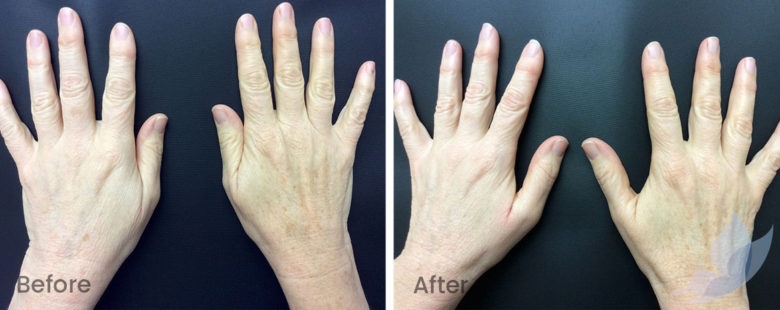 Sun damage - Hands - Austin Clinic