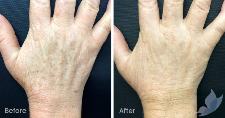 Sun damage - Hands - Austin Clinic