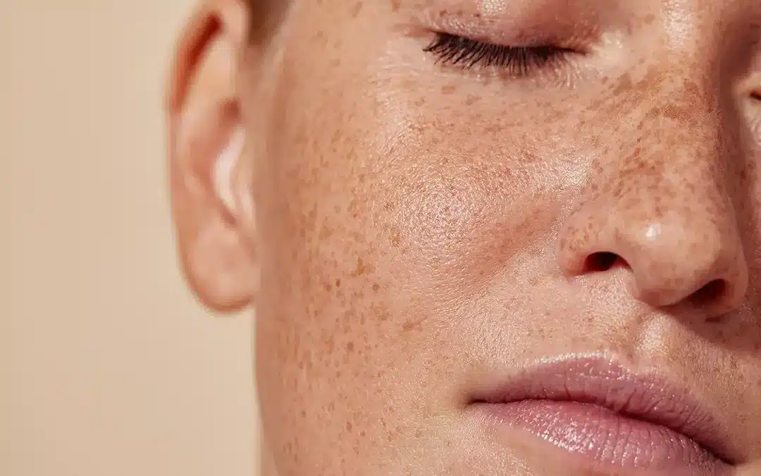 Pigmentation Archives - Austin Clinic